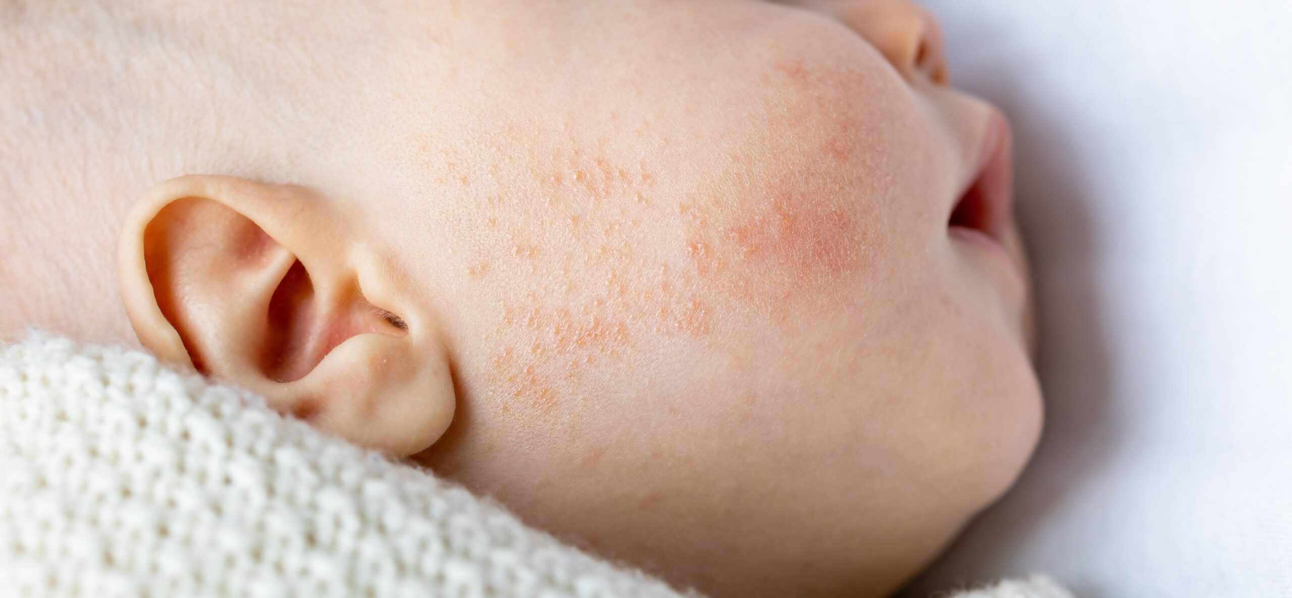 Skin conditions in newborns - Babycocole
